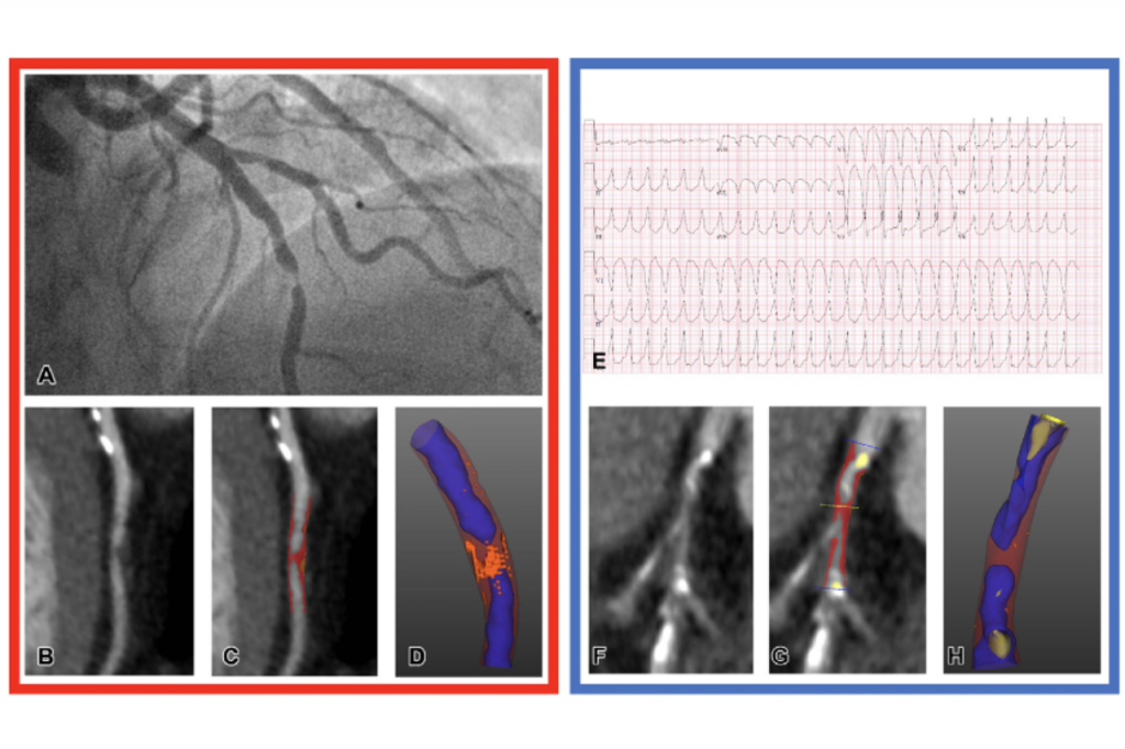 Distinguishing Type 1 from Type 2 Myocardial Infarction - Translational ...